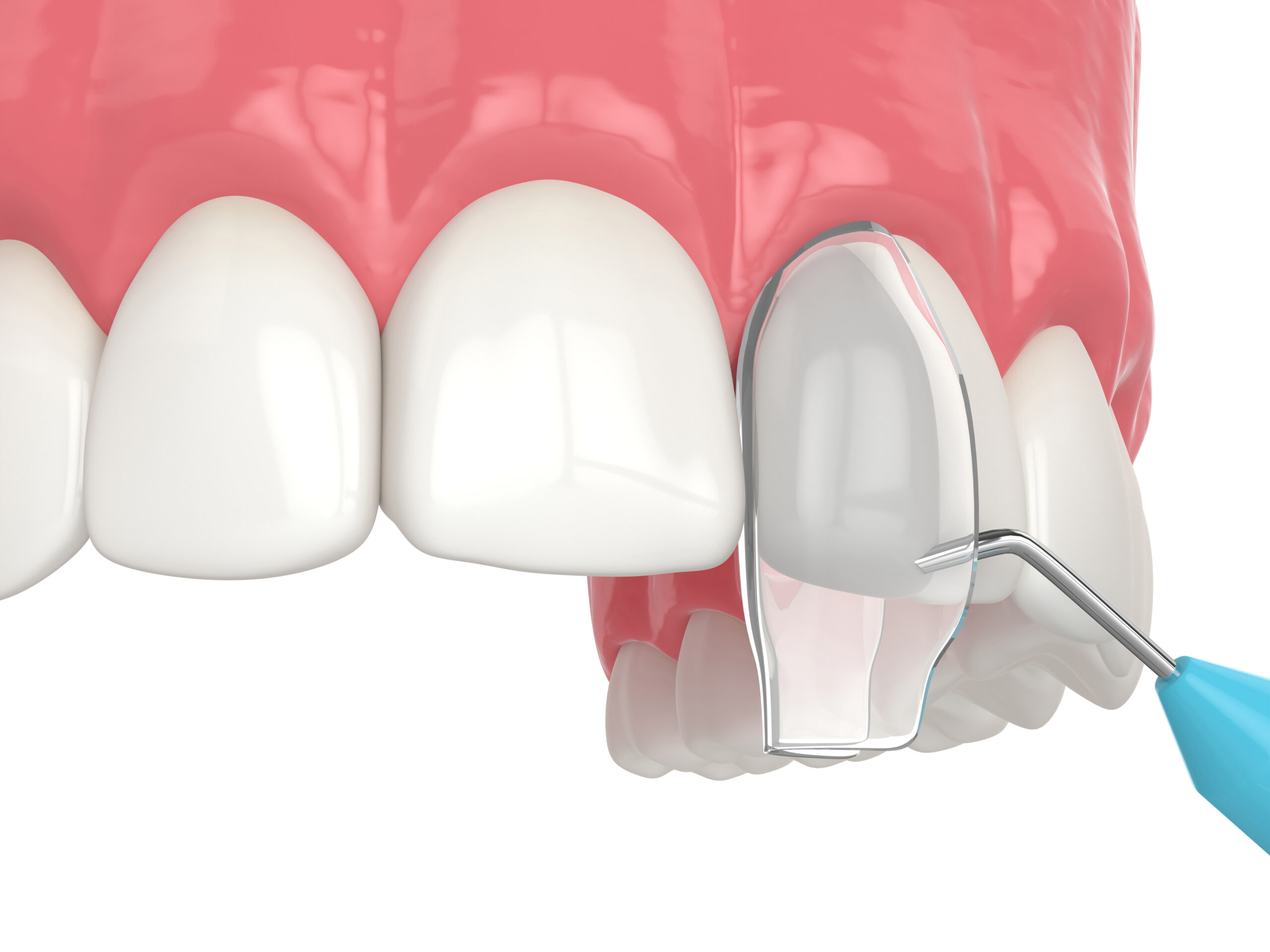One-Visit Treatment With Bonding | Prairie Village, KS