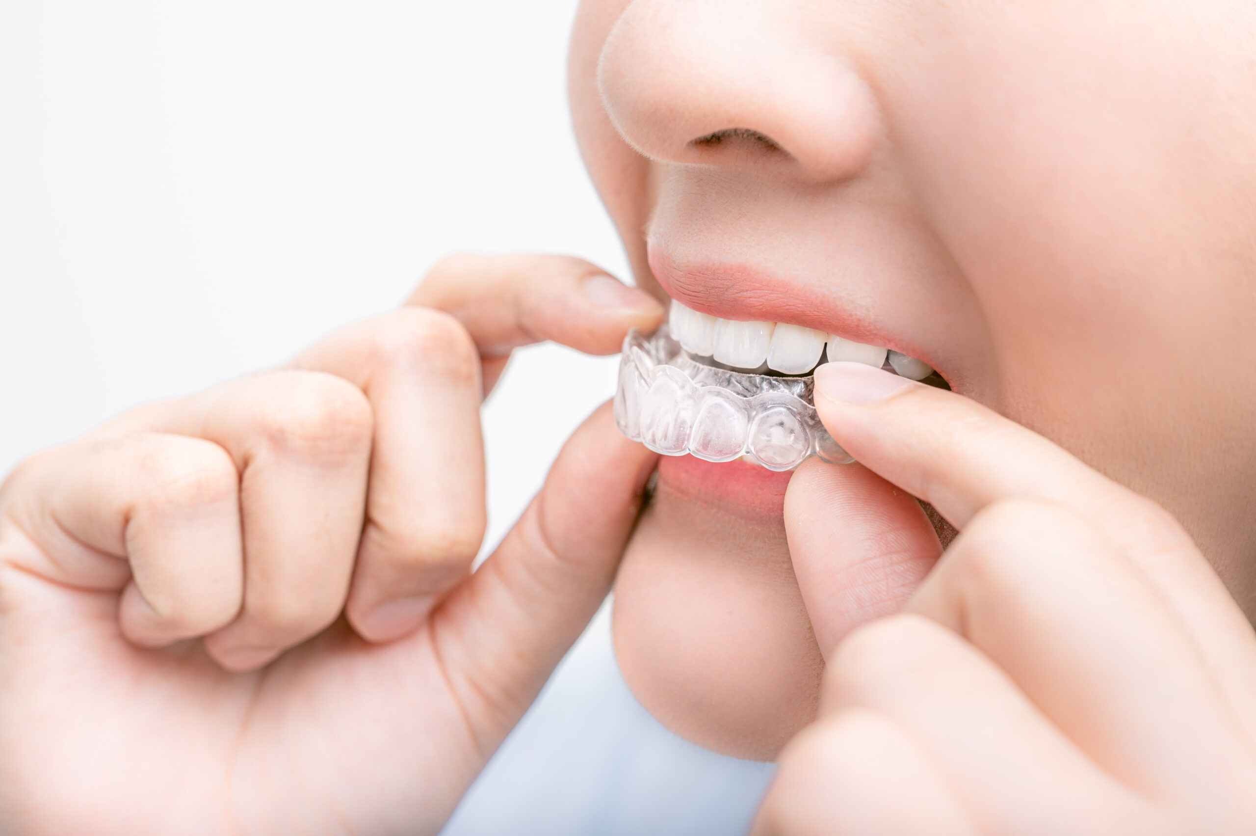 Cosmetic Orthodontics With Aligners | Prairie Village, KS