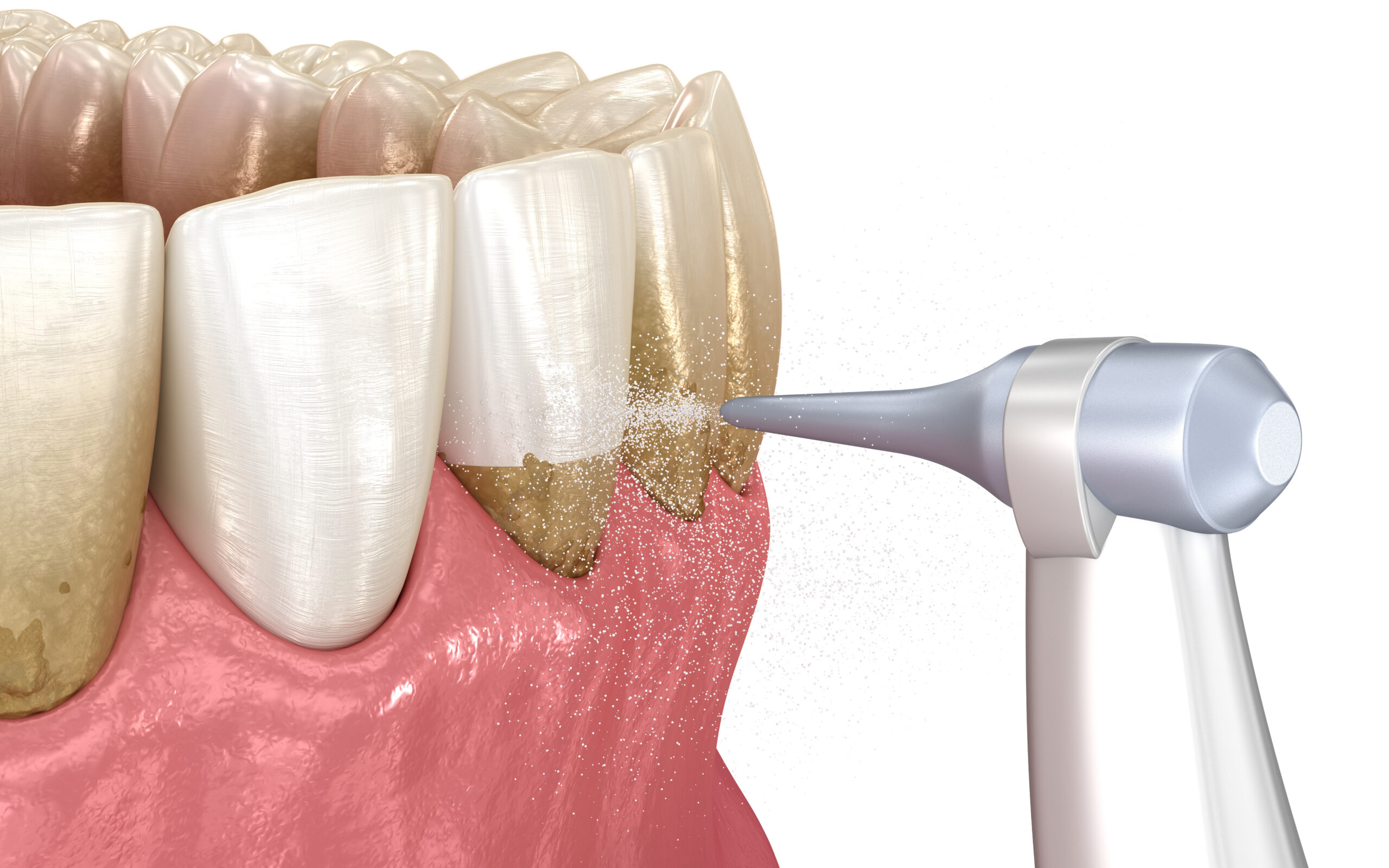 Checkups And Cleanings Safeguard Smiles | Prairie Village, KS