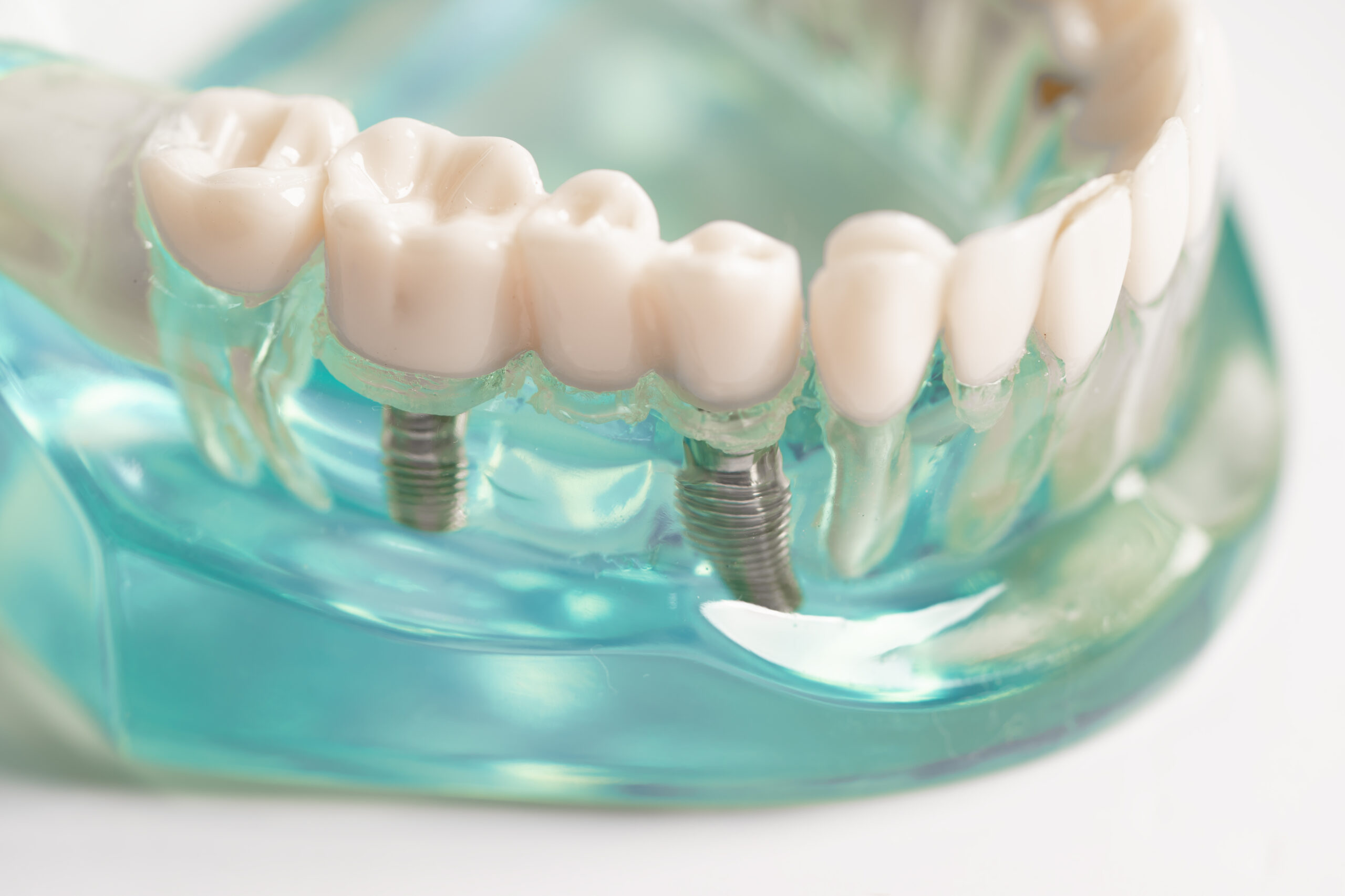 Securing New Teeth With Implants | Prairie Village, KS Securing New Teeth With Implants | Prairie Village, KS