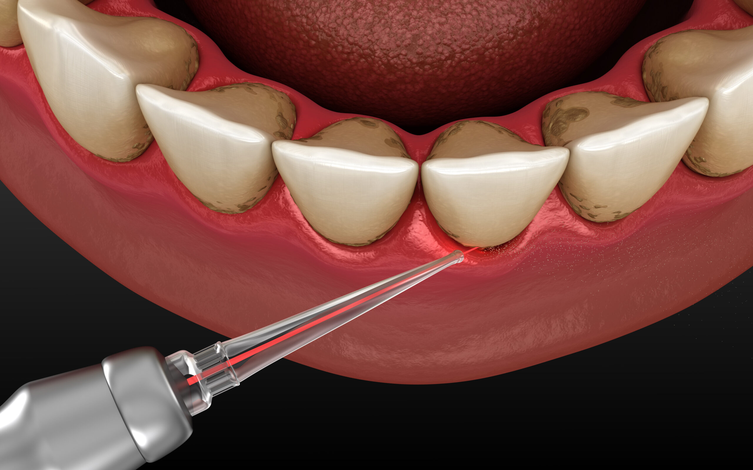 Improving Smiles With Gum Contouring | Prairie Village, KS