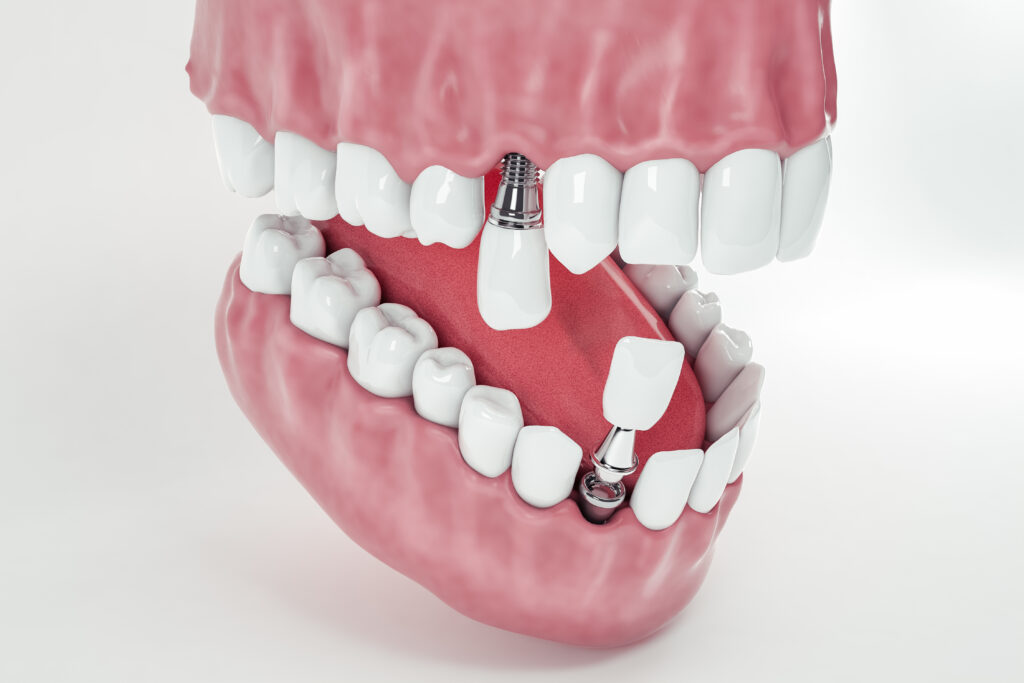 How We Secure Dental Implants | Prairie Village, KS