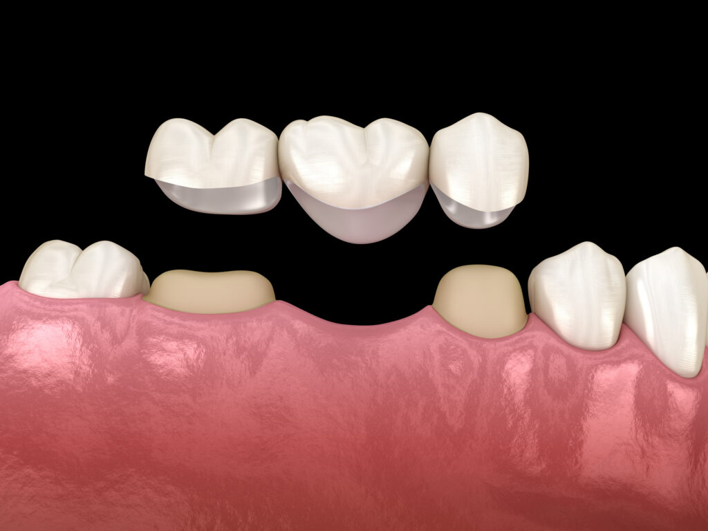 Replacing Missing Teeth With A Bridge | Prairie Village, KS