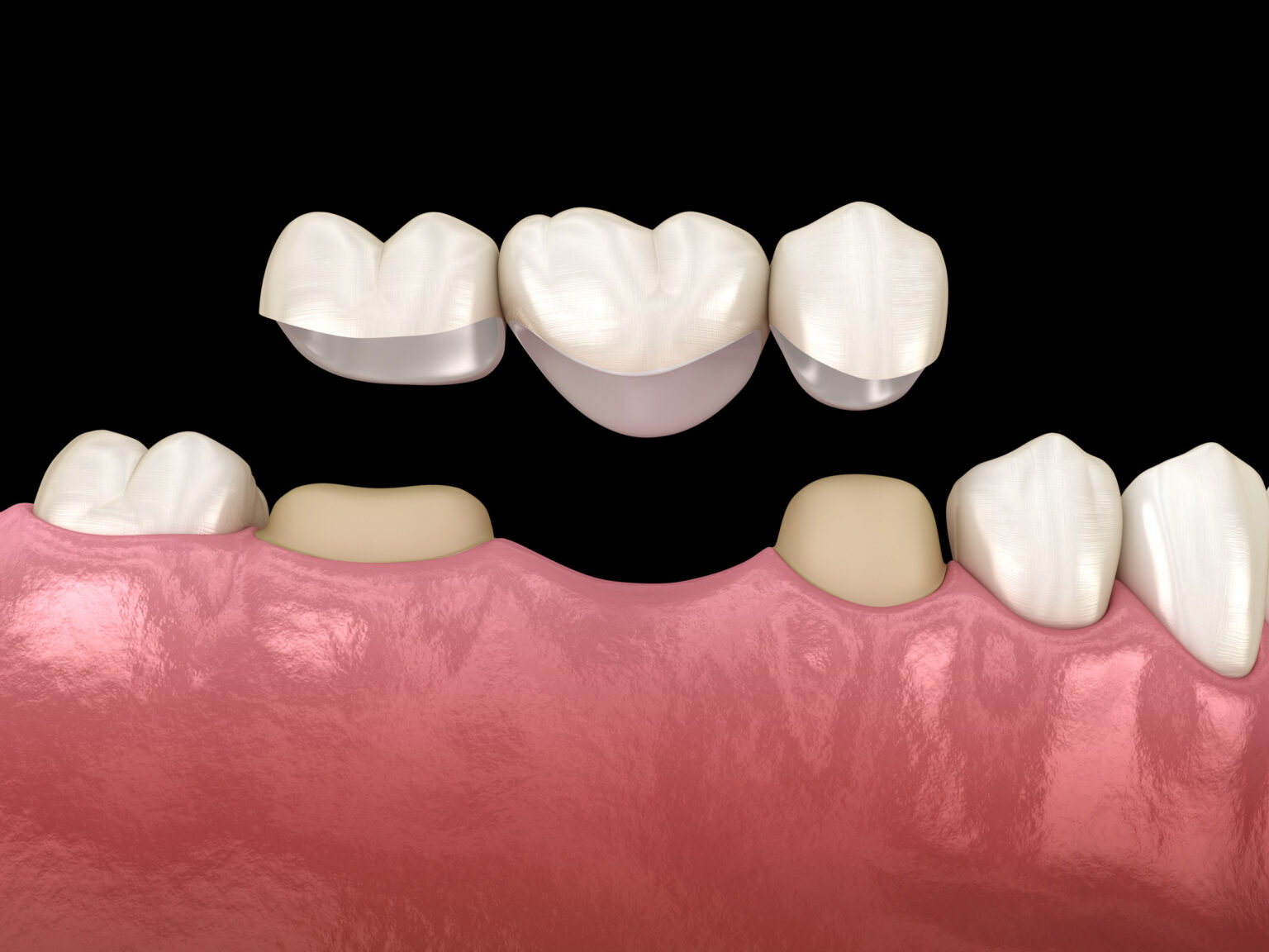 Replacing Missing Teeth With A Bridge | Prairie Village, KS